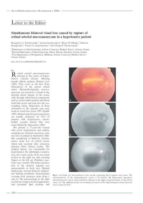 Pdf Simultaneous Bilateral Visual Loss Caused By Rupture Of Retinal Arterial Macroaneurysms In
