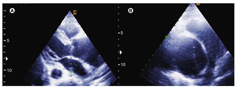 Transthoracic Echocardiography A Dilated Ascending Aorta In