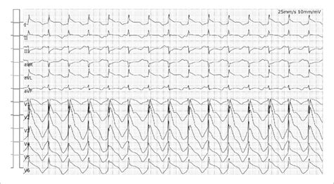 Ecg After 2 5 H Showed Marked St Segment Elevation In Leads V1 V6 I Download Scientific