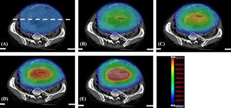 Difference In Dose Distributions In Patient 1 Between Con Imrt Plan And Download Scientific