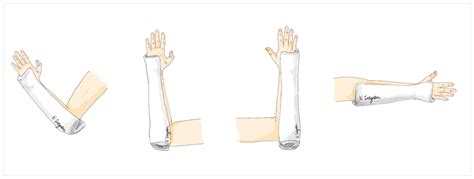 Comparative Analysis Of Treatment Outcomes Modified Ulnar Gutter Slab