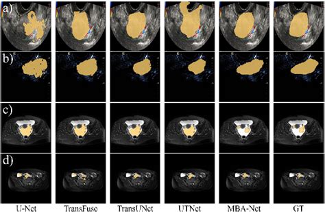 Mba Net Sam Driven Bidirectional Aggregation Network For Ovarian Tumor