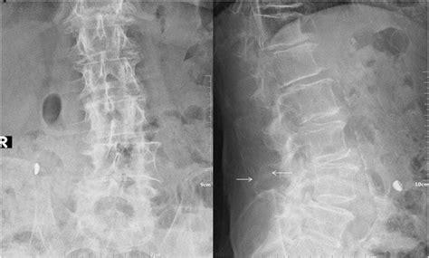 Lumbar Spine X Ray Ap Left Image And Lateral Right Image Views