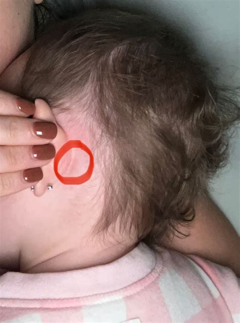 Swollen Lymph Nodes Behind Ear