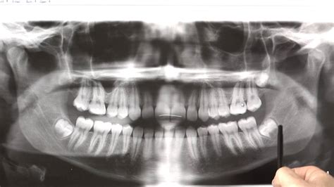 Impacted Wisdom Teeth Xray