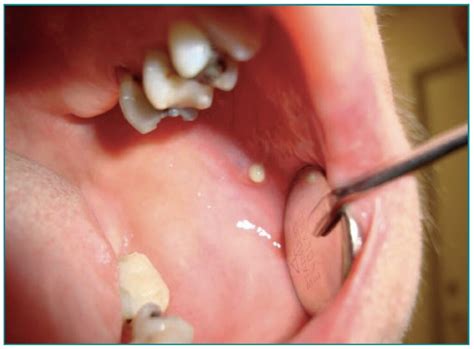Man Squeezes Salivary Stone Out From Tongue Jcdat