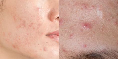 Old Makeup Causes Acne Saubhaya Makeup