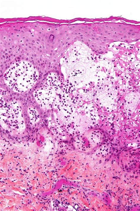 Gestational Pemphigoid Alchetron The Free Social Encyclopedia