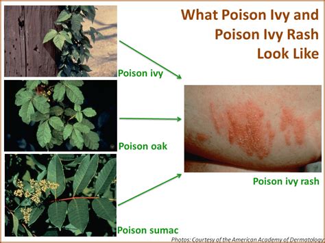 Poison Ivy Rash Causes What Does Poison Ivy Rash Look Like Symptoms