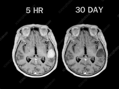 Brain After Stroke Mri Scans Stock Image F0431437 Science Photo