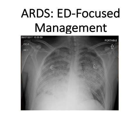 EmDOCs Net Emergency Medicine EducationAcute Respiratory Distress Syndrome ARDS Whos At