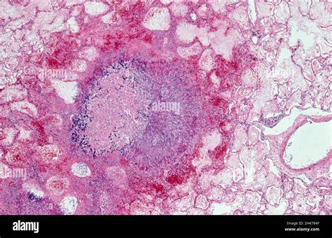 Aspergillosis Histology