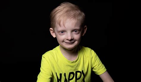 Ectodermal Dysplasia Ectodermal Dysplasia