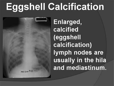 Egg Shell Calcification Radiology Classroom Facebook