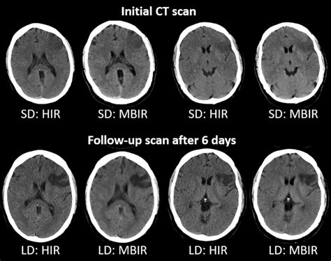 Initial Sd Ncct Upper Row And Follow Up Ld Ncct Lower Row Of