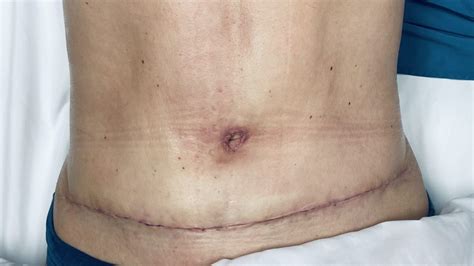 Benefits Of Lymphatic Massage Post Plastic Surgery