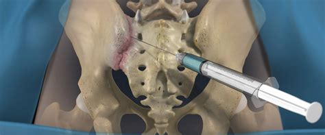 how long does it take for facet joint injections to start working