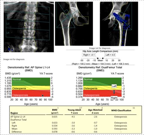 Bone Density Test Cpt Code 2025 Enrique Miles