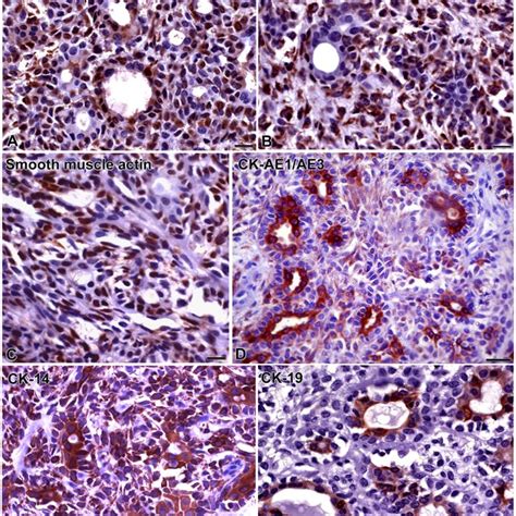 Pleomorphic Adenoma Expresses Epithelial And Myoepithelial Markers In