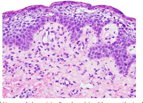 Zinc Deficiency Acrodermatitis Enteropathica Nutritional Pathology