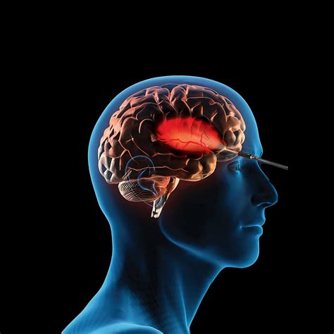 World Tumour Day Experts Bust Myths On Brain Tumour Bw Healthcare World