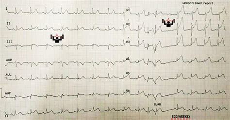 Differential Diagnoses Diffuse St Segment Elevation Without Reciprocal St Segment Depression
