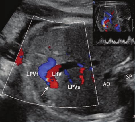 A Representative Sonogram Of Case 8 A Transverse Scan Shows A Shunt Download Scientific