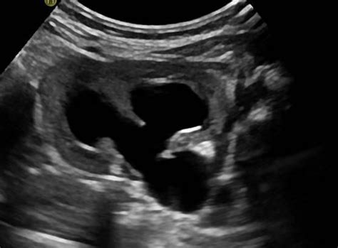 Pediatrics 9 2 Pediatric Urinary Tract Case 9 2 2 Reflux