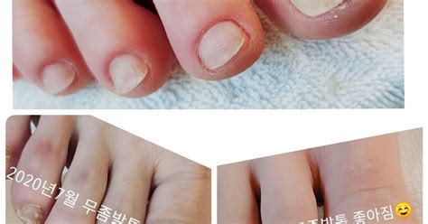 내성발톱and무좀발톱 관리의 중요성 야민네일 숨고 숨은고수