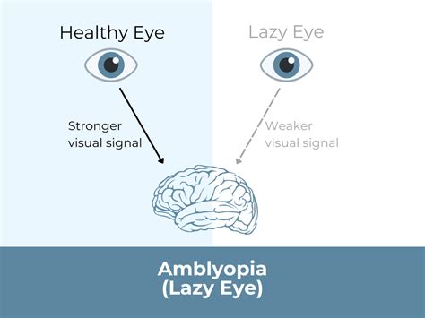 Amblyopia Treatmentlazy Eye Causes Diagnosis And Treatment