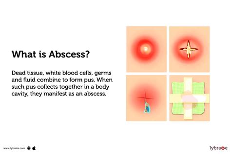 Abscess Symptoms Causes Treatment Cost And Side Effects