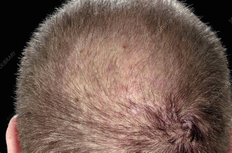 Folliculitis Scalp