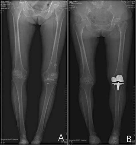 How To Take X Ray Of Leg