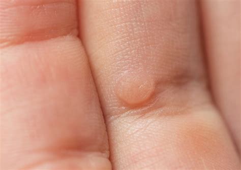 Warts And Verrucae Define Aesthetic Clinic