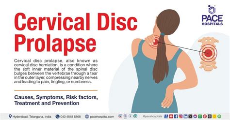 Cervical Disc Prolapse Symptoms Causes And Treatment
