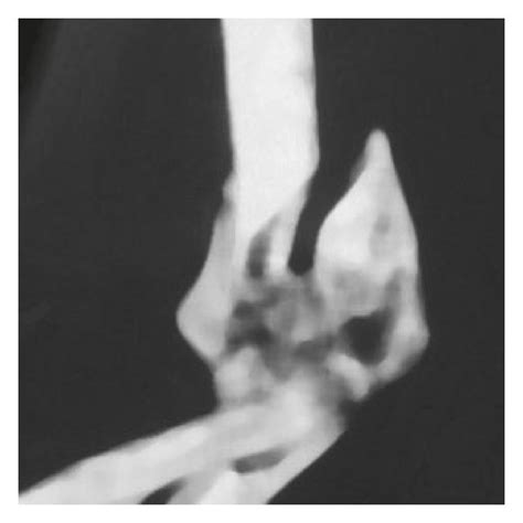 Visual Comparison Of Elbow Ct Images Optimized And Processed In Download Scientific Diagram