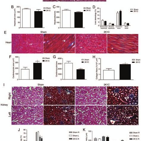 Parvus Et Tardus Waveform Appearance In A 16 Year Old Girl A