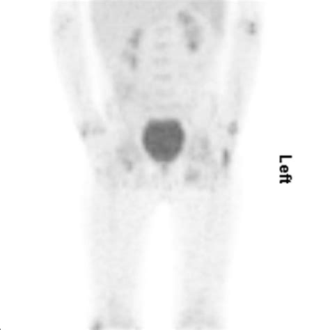 Maximum Intensity Projection Of The Patient The Projection Shows