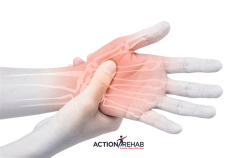 Metacarpal Fractures Causes And Recovery Action Rehab