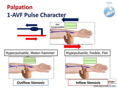 How To Examine AVF In 10 Minutes Dr Gawad PPTX Blood Disorders Diseases And Conditions