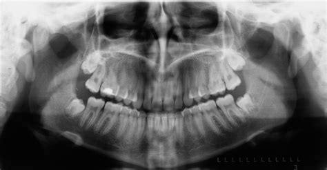 Maxillary Sinuses Dr Gs Toothpix