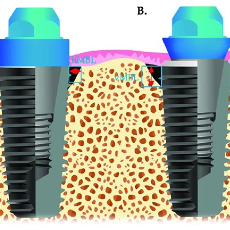Radiographic Measurements Of The Platform Switched And Platform Matched Download Scientific