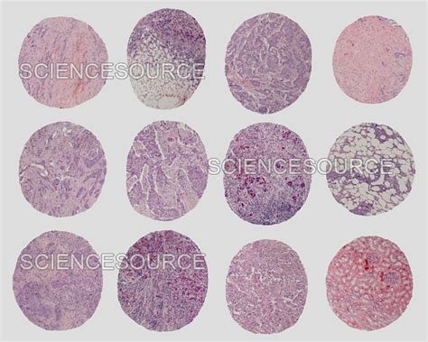 Tissue Microarray Light Micrograph Stock Image Science Source Images