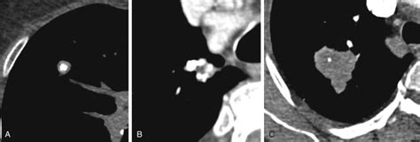 Incidental Pulmonary Nodule Clinical Tree