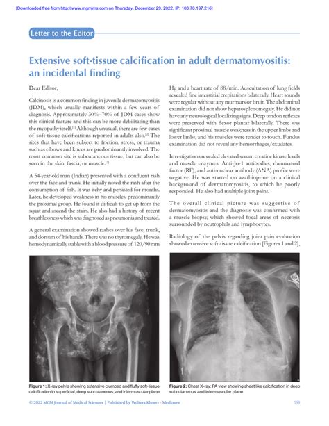 Pdf Extensive Soft Tissue Calcification In Adult Dermatomyositis An Incidental Finding