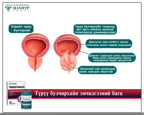 ТҮРҮҮ БУЛЧИРХАЙН ТОМРОЛЫН ЭМЧИЛГЭЭГ ХЭЗЭЭНЭЭС ЭХЛЭН ХИЙХ ВЭ “ЦАХИУР ТӨМӨР” ХХК