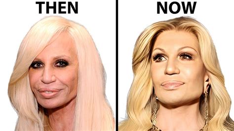 Best 13 Donatella Versaces New Face Plastic Surgery Analysis Artofit