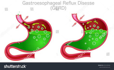 Gastroesophageal Reflux Disease Gerd Stomach Anatomy Stock Vector