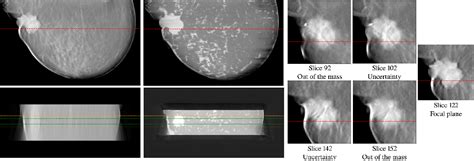 Figure 1 From A Deep Learning Method Trained On Synthetic Data For Digital Breast Tomosynthesis