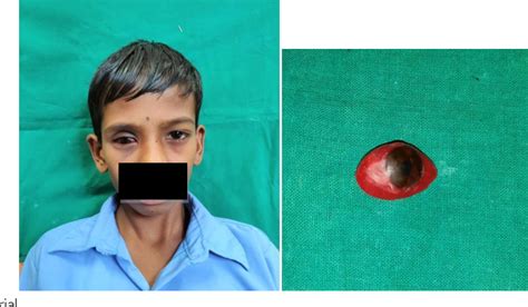 Figure 7 From Prosthetic Rehabilitation Of An Ocular Defect A Case